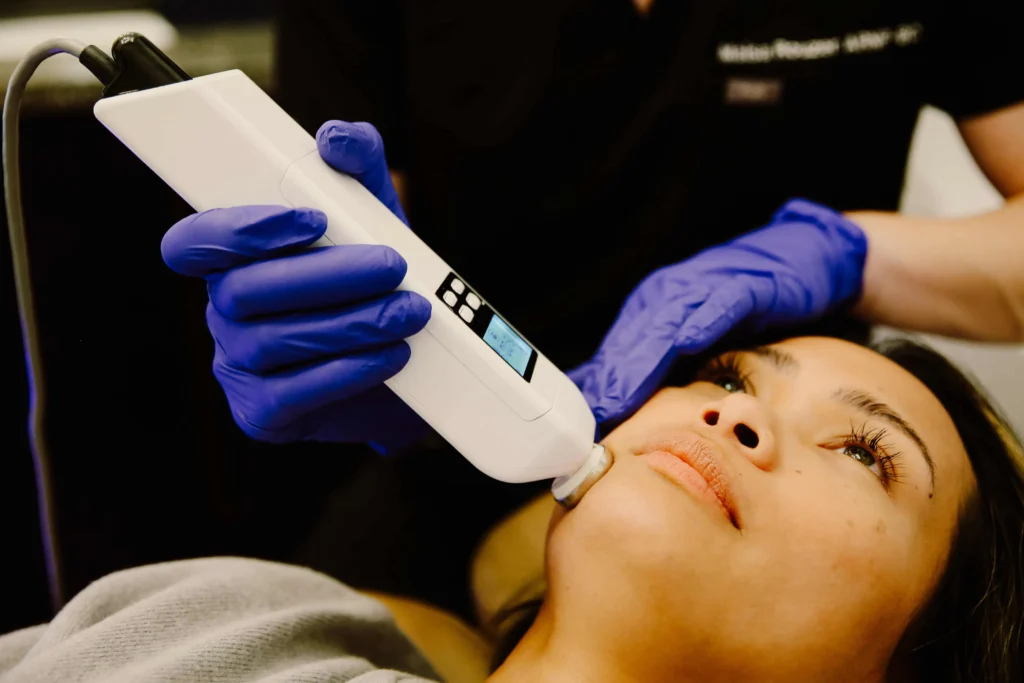 Professional Scarlet SRF Microneedling in Kirkland, WA | LWM